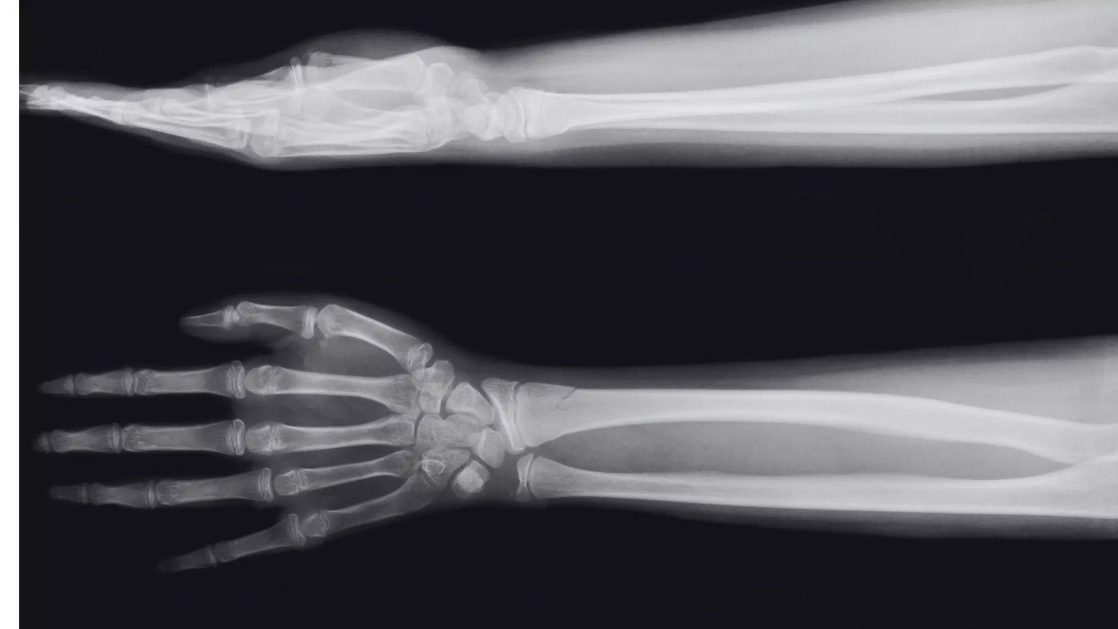 Fratura do Antebraço - Dr. Eduardo Araujo